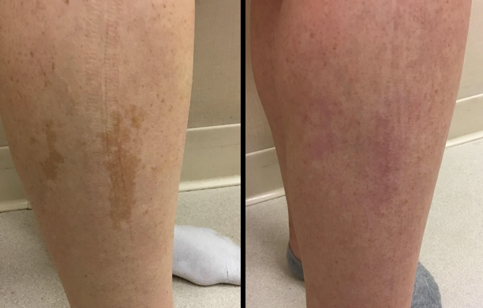 Everything You Need to Know About PicoWay® Laser | Dr. Ariel Ostad, MD