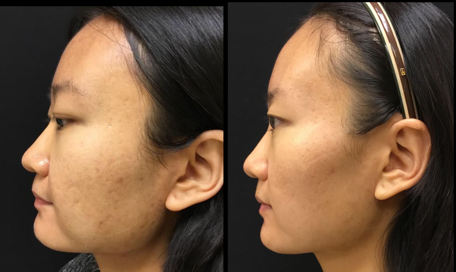 Scar Revision: Traumatic Scars, Acne Scars, and Stretch Marks | Dr ...