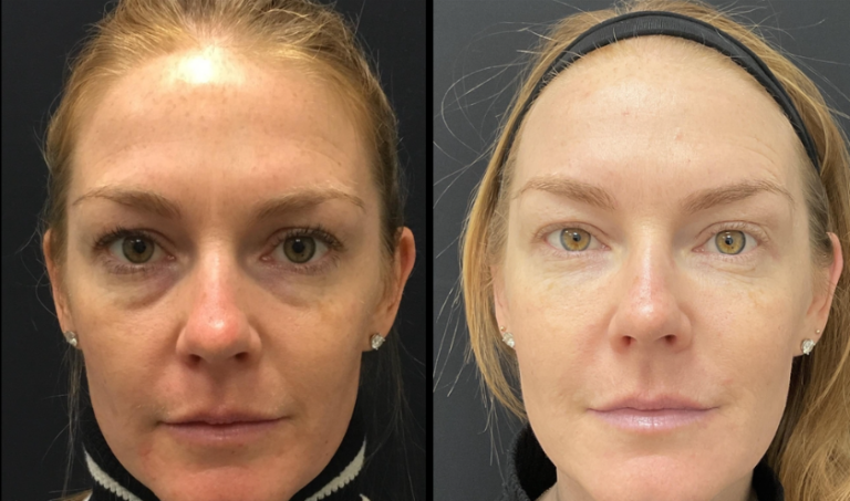 Benefits of Using Fillers After Weight Loss | Dr. Ariel Ostad, MD