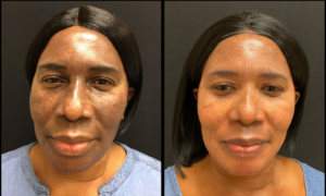 Living With Melasma – What Causes It and How to Treat It | Dr. Ariel ...