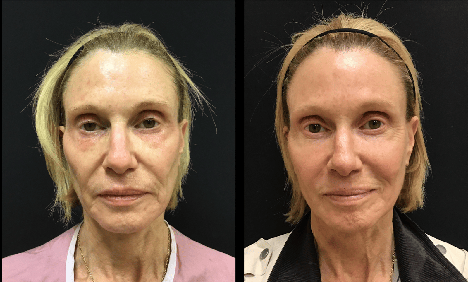 The Science of Collagen: How to Keep Your Skin Firm and Youthful | Dr ...